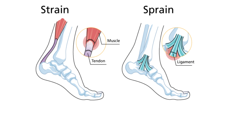How to Treat a Sprained Ankle | Sterosport