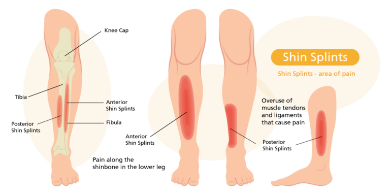 Preventing And Treating Shin Splints Sterosport